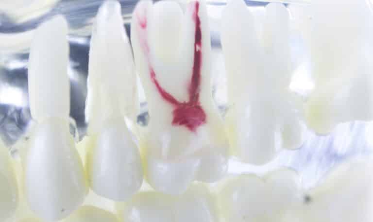 A Complete Guide To Kids Root Canals